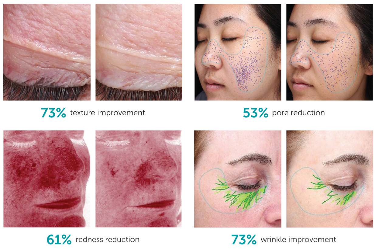 Results – FACTORFIVE Skincare